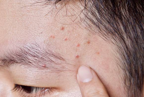 Precise Solutions for Pimples on Temples - Free Bunni